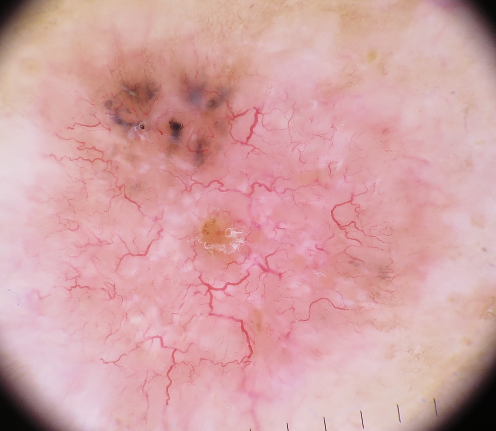 Summerland Skin Cancer Clinic | » Basal Cell Carcinoma